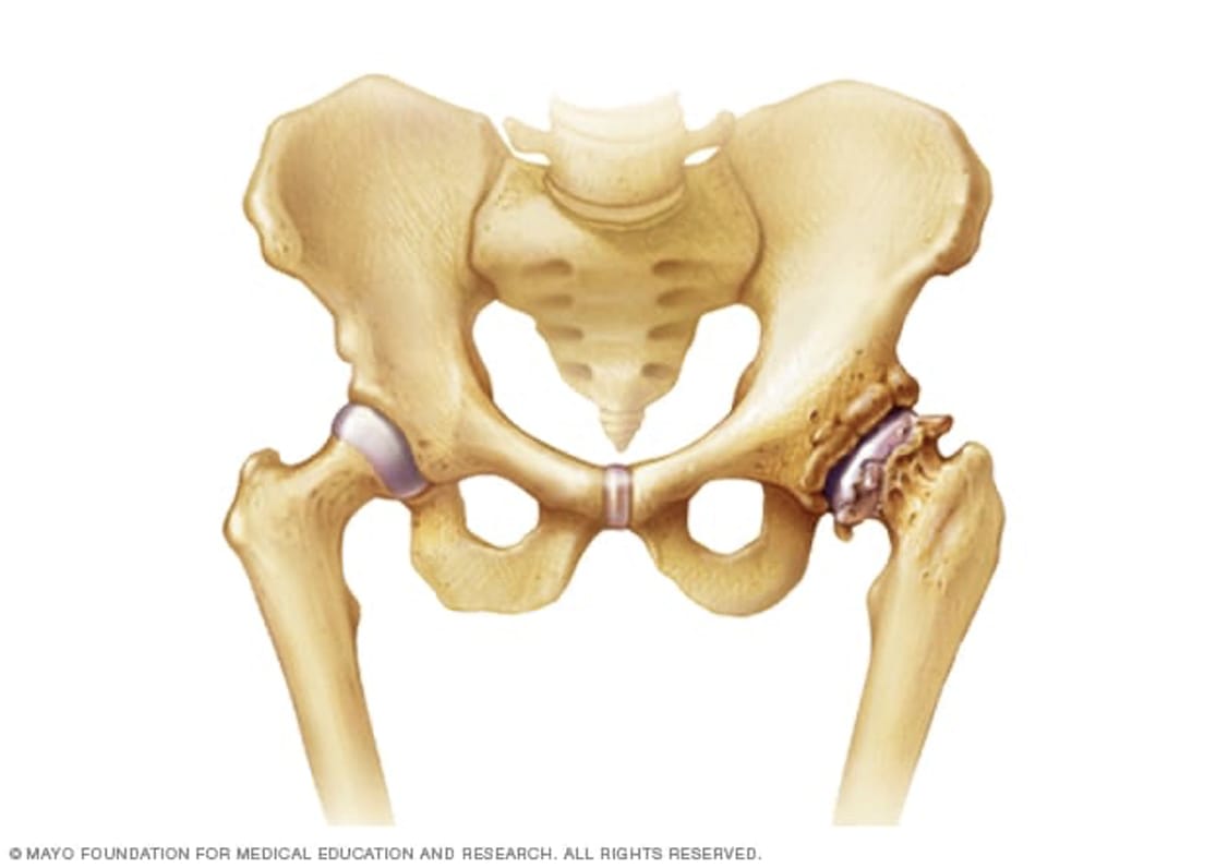 Pengapuran Sendi Panggul Osteoarthritis Hip 