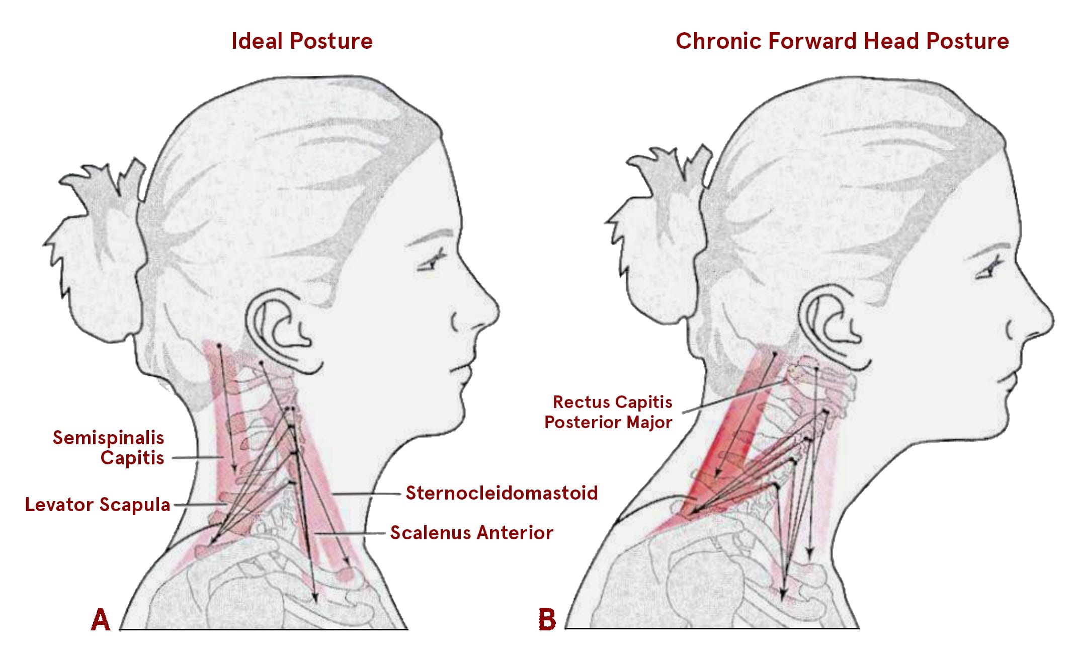 Forward Head Posture I Text Neck Penyebab Dan Bagaimana Mengatasinya