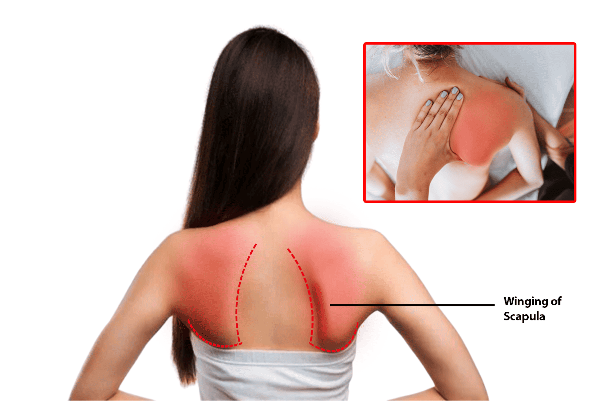 Penyebab Tulang Belikat Menonjol I Winged Scapula Klinik Tulang